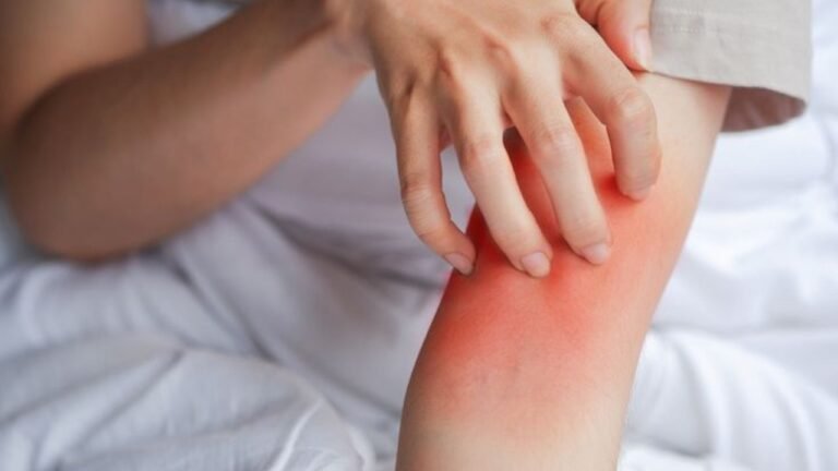 Burning Skin Rash on Hands: Causes, Symptoms, and Effective Treatments ...