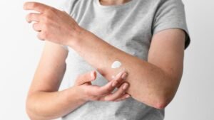 Best Dyshidrosis Cream: Find Relief for Your Itchy Blistered Hands ...